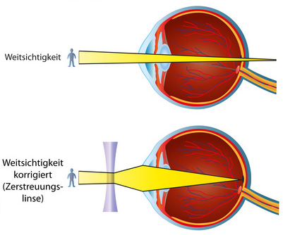 Weitsichtigkeit / Hyperopie: Dr. Irmgard Gruber - Augenärztin 1040 Wien